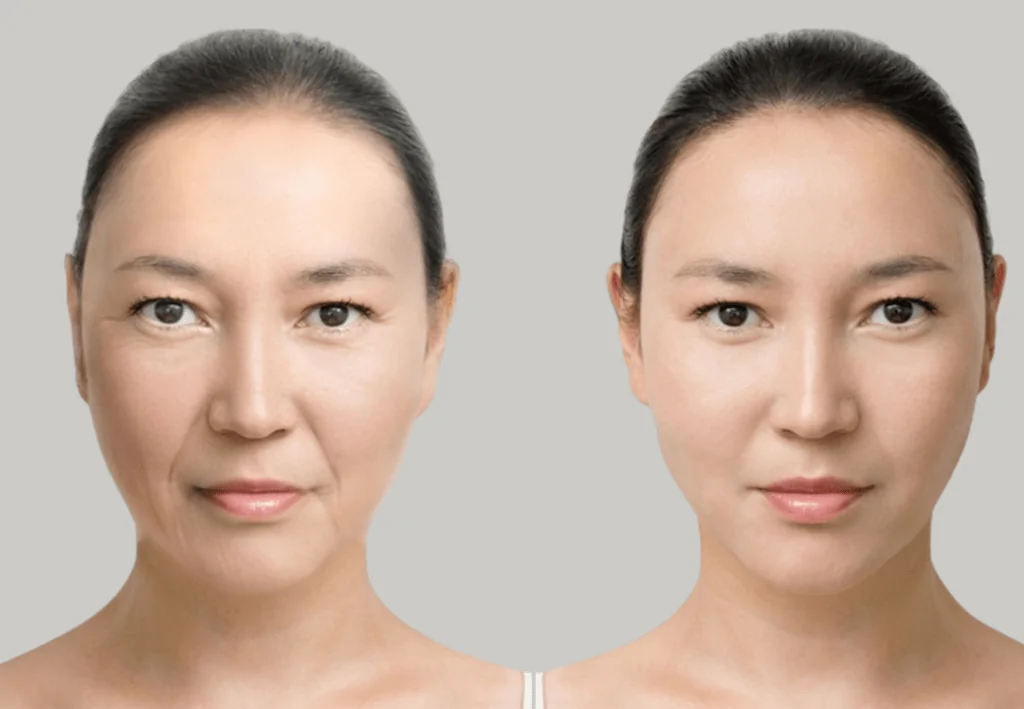 Botox Injection In Dubai UAE | Botox Treatment