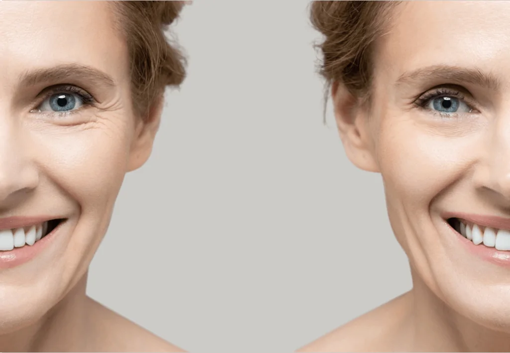 Botox Injection In Dubai UAE | Botox Treatment